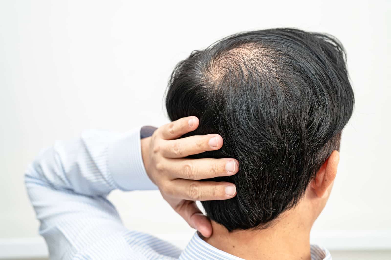 Finasteride and Its Influence on Hormonal Balance: What to Expect