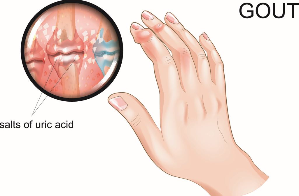 Understanding The Different Stages Of Gout