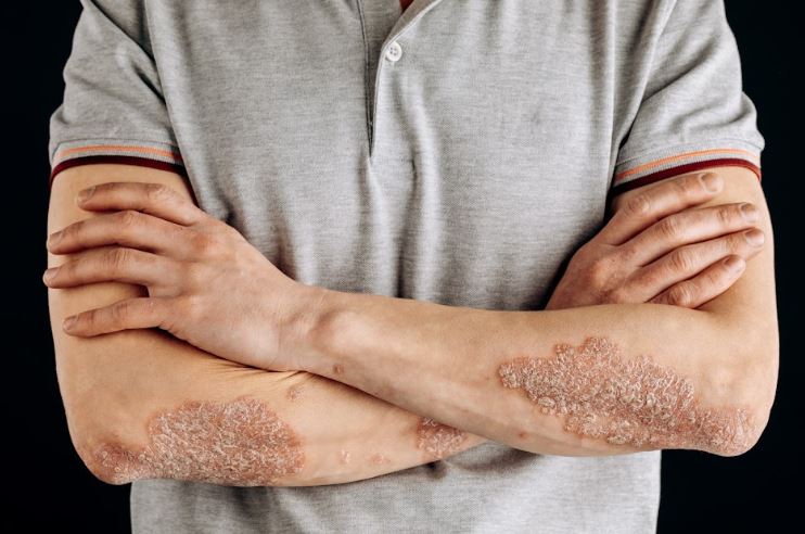 What Is Acute Dermatitis? How To Treat It Using Medication?